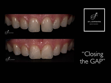Dentist Cape Town | JJ Teeth | Dr JJ Serfontein